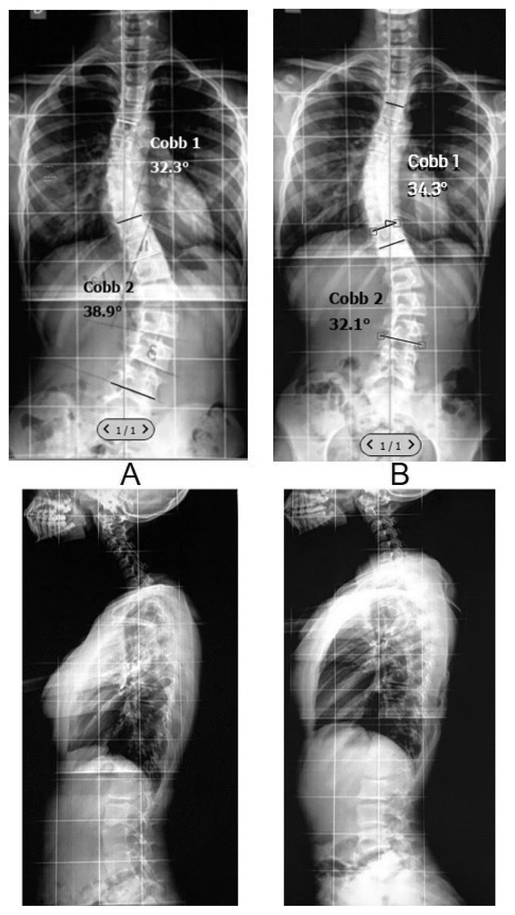 Case Report on Visceral Manipulation in Adolescent Idiopathic Scoliosis